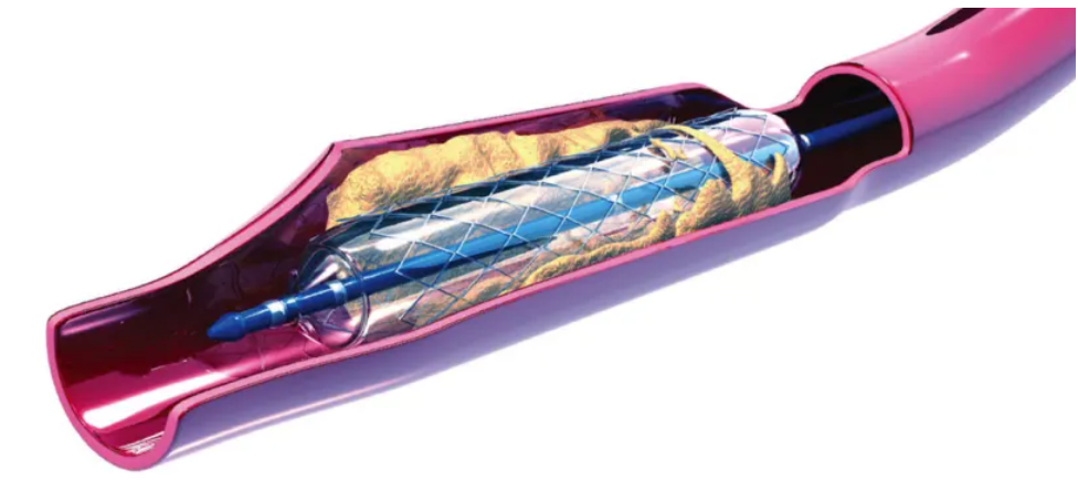 The Use of Parylene-Coated Mandrels in the Balloon Catheter ...